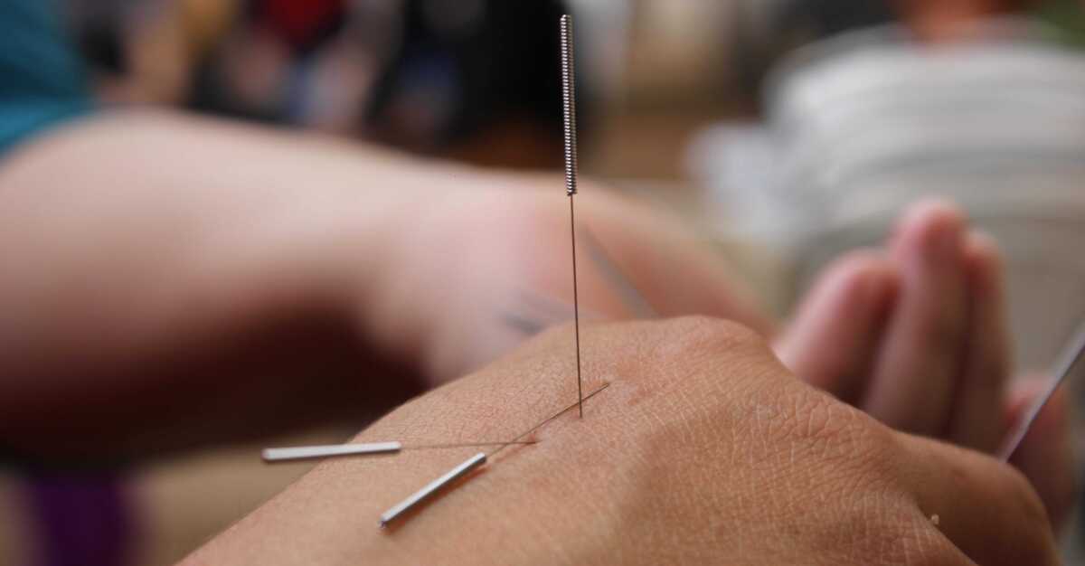 Intramuscular Stimulation (IMS) & Dry Needling | West 4th Physiotherapy ...